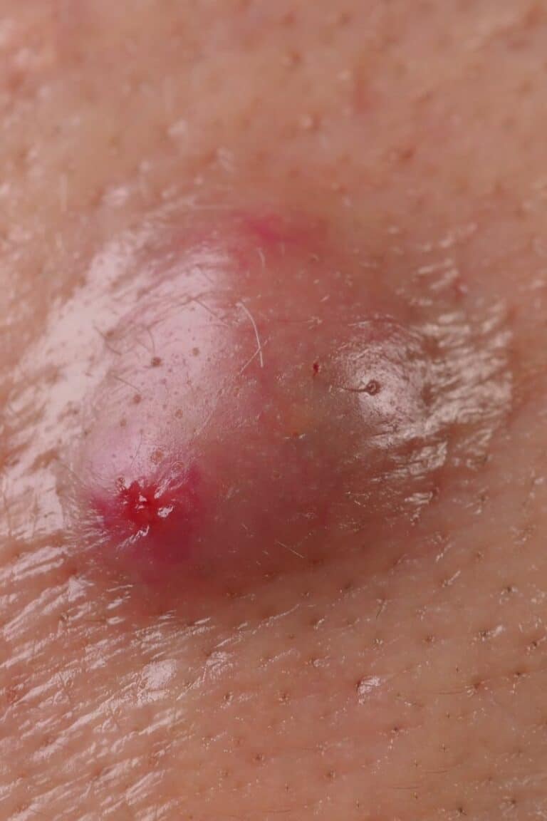 Simple Sitz Bath Recipe For Bartholin Cyst Remedy